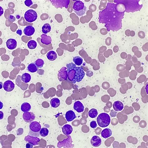 Mott Cells Rmedlabprofessionals