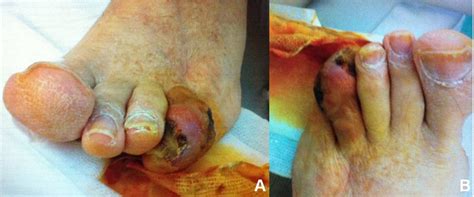 Figure1 Clinical Aspect Of The Lesion Note The Necrotic Mass Beneath
