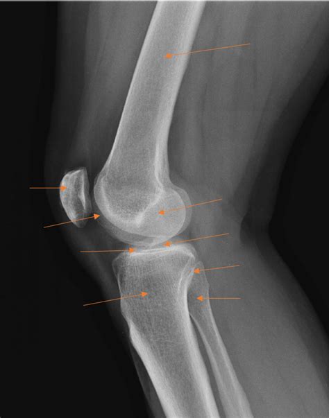 Lateral Right Knee Diagram Quizlet