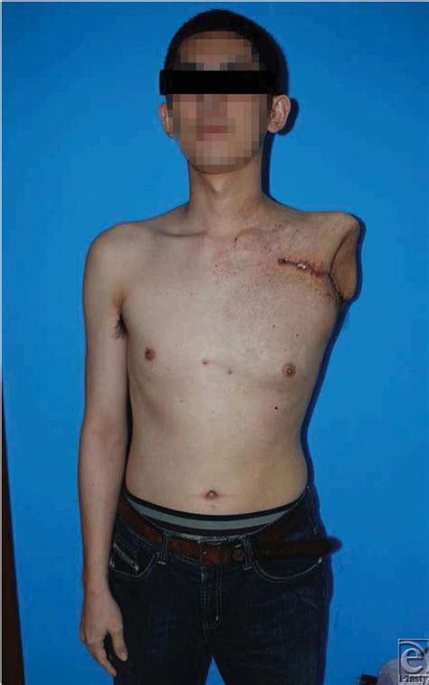 Bilateral Transfemoral Amputation