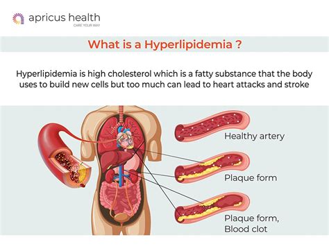 Understanding Hyperlipidemia Causes Symptoms And Treatment Options Ask The Nurse Expert