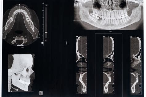 Tmj Arthritis Ct Scan At Victoria Ranford Blog
