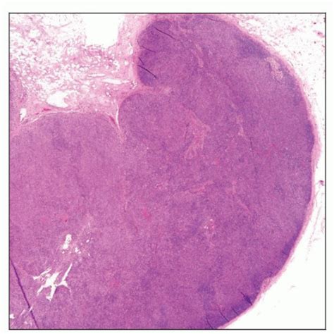 Mixed Cellularity Hodgkin Lymphoma Basicmedical Key