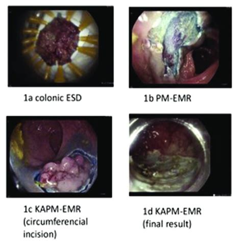 Examples Of Different Resection Type Esd Endoscopic Submucosal