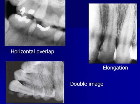 Dental Panoramic X Ray Errors At Kermit Bourdon Blog