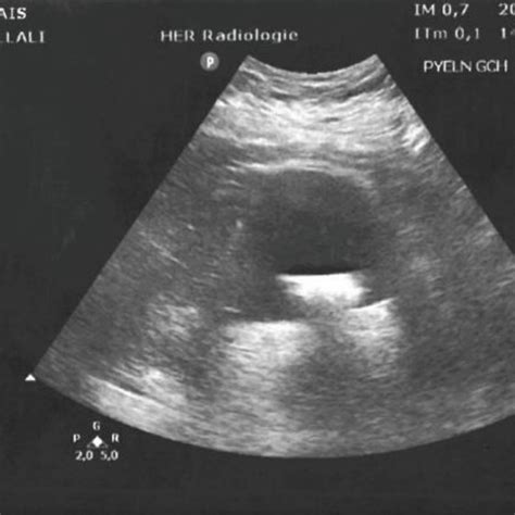 Malpositioned Iud With One Arm Inside The Myometrium Arrow