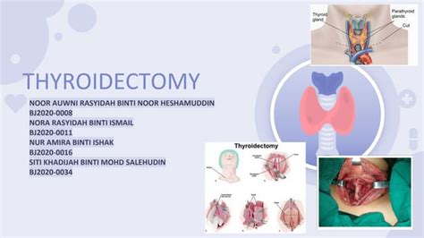 Thyroidectomy Notes Slides For Nursing Student Pdf