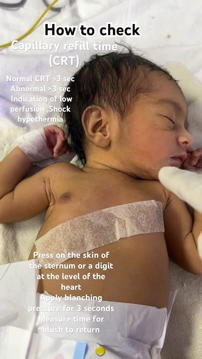 Capillary Refilling Time How To Assess Youtube