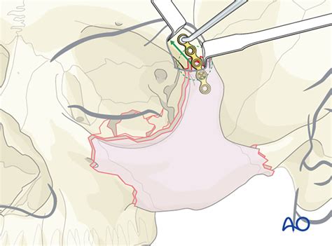 Orif 3 Point Fixation With Orbital Reconstruction For Zygoma Zygomatic Complex Fracture
