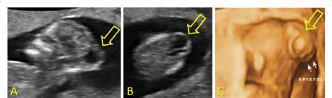 Isolated Encephalocele In The First Trimester 2d Axial A And