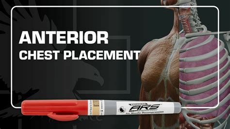 Anterior Chest Placement For The Second Intercostal Space When