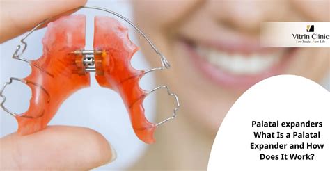 Palatal Expanders What Is A Palatal Expander And How Does It Work