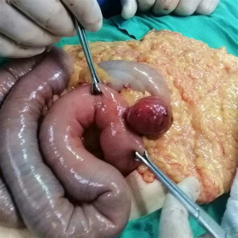 Segmental Small Bowel Resection Download Scientific Diagram