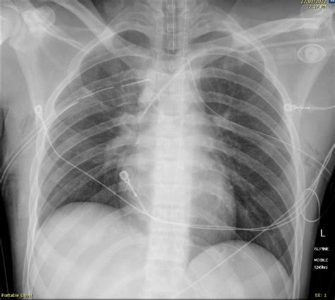 Figure 3 From Subcoracoid Acromioclavicular Joint Dislocation Rockwood