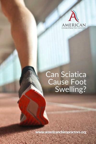Can Sciatica Cause Foot Swelling American Chiropractors