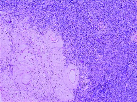Photomicrograph From Section Of The Right Ovary Showed Granulosa Cells