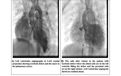 Gerbode Defect Closure A Left Ventricular Angiography In Lao Cranial