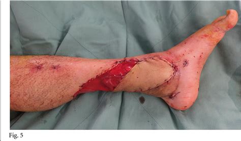 Figure 5 From Ankle Skin Defects With Vascular Ehlers Danlos Syndromes