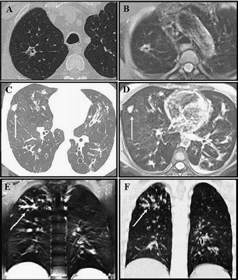 A Ct Image Of Peripheral Bronchial Wall Thickening In A Patient With Download Scientific