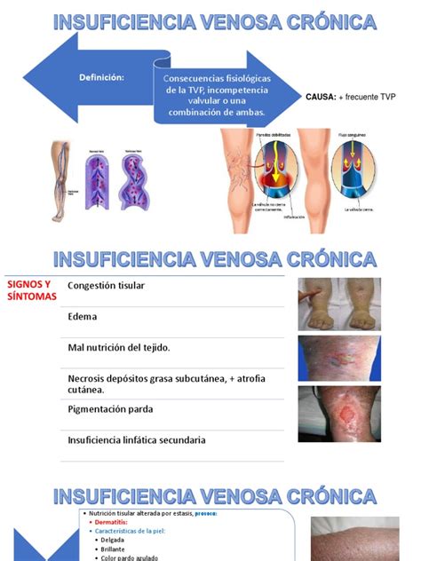 Insuficiencia Venosa Crónica Y Trombosis Venosa Profunda Y Superficial