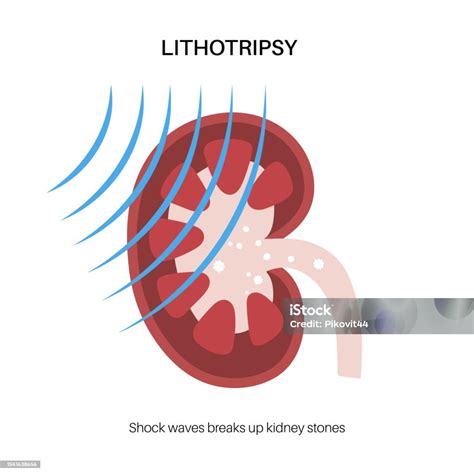 Lithotripsy Procedure Concept Stock Illustration Download Image Now