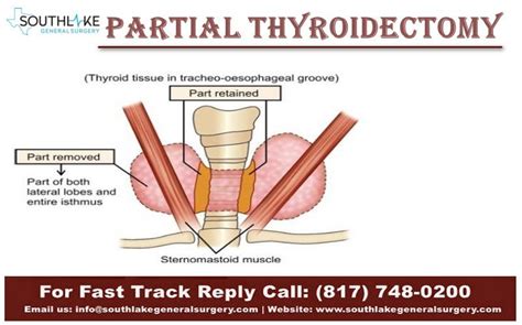 Partial Thyroid Removal Surgery And Recovery Rlaparoscopy