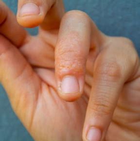 Mild Dyshidrotic Eczema