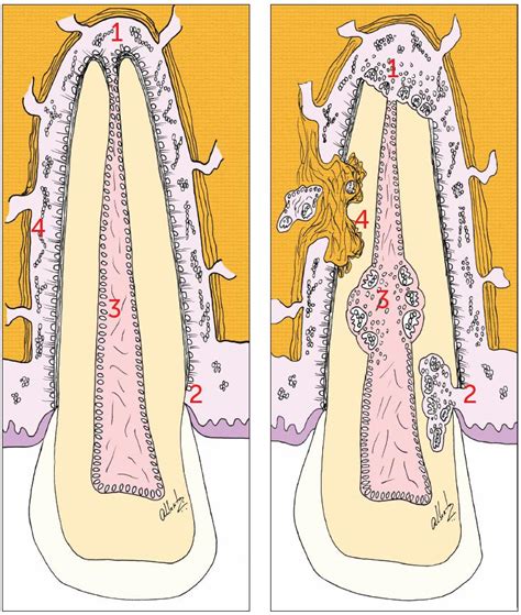 External Resorption Of Tooth