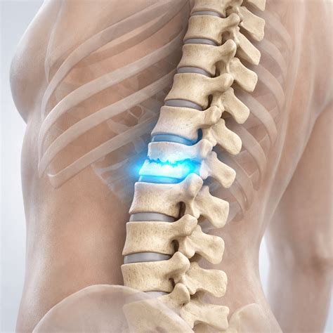 Spinal Compression Fractures Symptoms And Treatment Spine