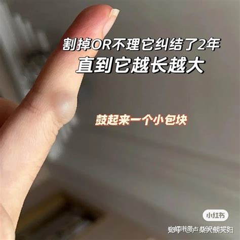手指上的血管瘤怎么治 知乎