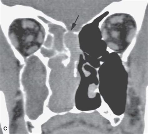Infectious And Noninfectious Inflammatory Disorders Reactive Bony