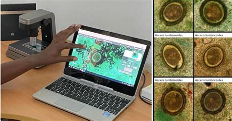 Ai Plays Critical Role In Intestinal Worm Infection Screening Among