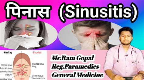 Sinusitisपिनासcauses Symptoms How To Treat Sinusitis In Nepali Youtube