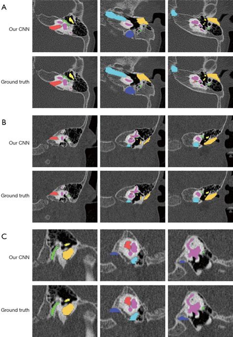 Deep Learning Based Approach For The Automatic Segmentation Of Adult And Pediatric Temporal Bone