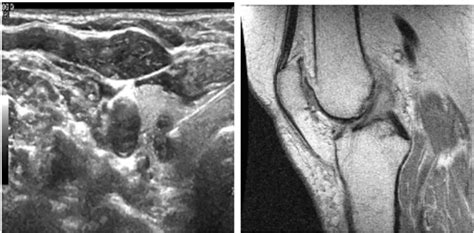 논문 리뷰 Towards Optimal Convolutional Transfer Learning Architectures For Breast Lesion