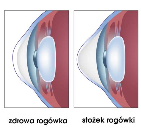 Co To Jest Rogówka Choroby Stożek Rogówki And Leczenie Instytut Oka