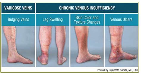 Are Your Legs Swelling Due To The Summer Heat Cvr Vein
