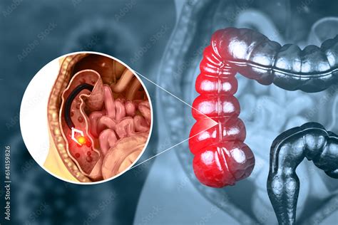 Colon Cancer Colon Polyp Removal Endoscope Inside Colonoscopy For Colon Polyps Search 3d
