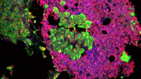 Long Term Benefit Of Radiotherapy Confirmed In Advanced Prostate Cancer