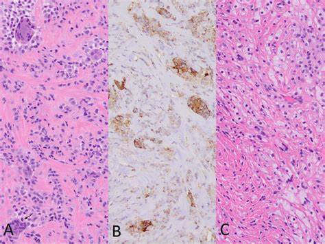 A Osteoclast Like Giant Cells Small Histiocytoid Cells And Larger Download Scientific