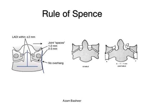 Upper C Spine Fractures Azam Basheer