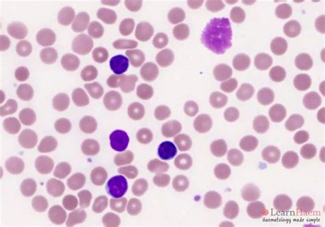 Chronic Lymphocytic Leukaemia Learnhaem Haematology Made Simple
