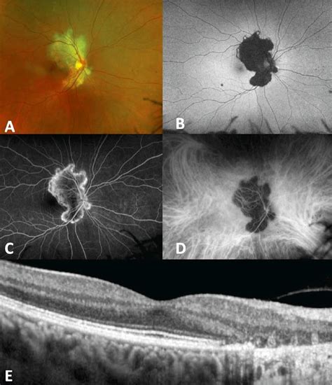 Retina Heres How A Case Of Serpiginous Choroiditis Appears On