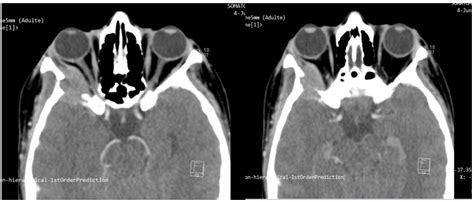 Fulltext Unusual Manifestations Of Orbital Langerhans Cell