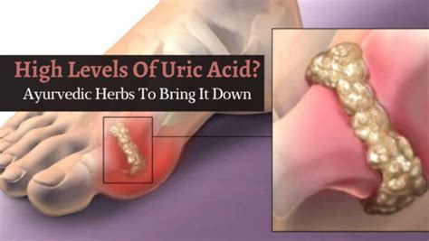 Uric Acid Crystallization Causes Gout And Joint Inflammation Heres 4