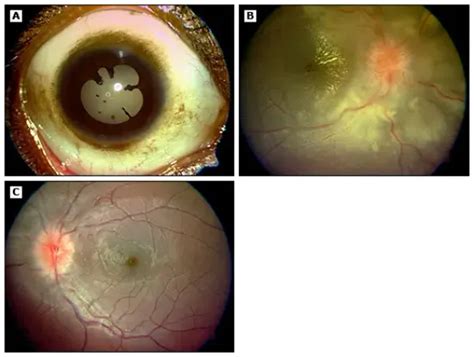Choroidal Tubercles