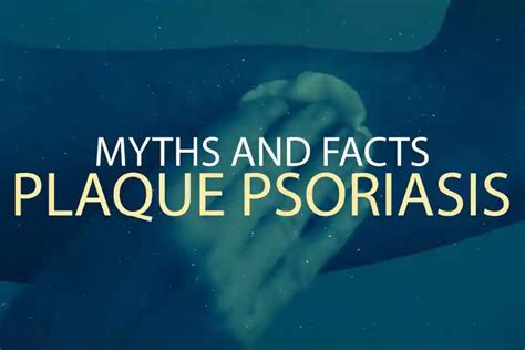 Myths And Facts Plaque Psoriasis