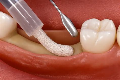 D7311 Alveoloplastik Tandemælkode For En Glat Genopretning