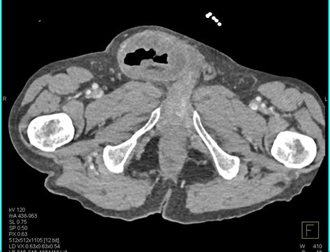 Inguinal Hernia Ct Scan