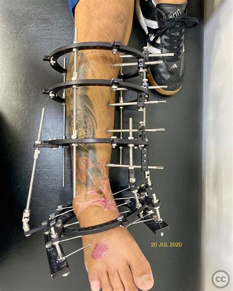 Staged Debridement Transport And Nailing Of An Open Distal Tibia With Critical Bone Defect
